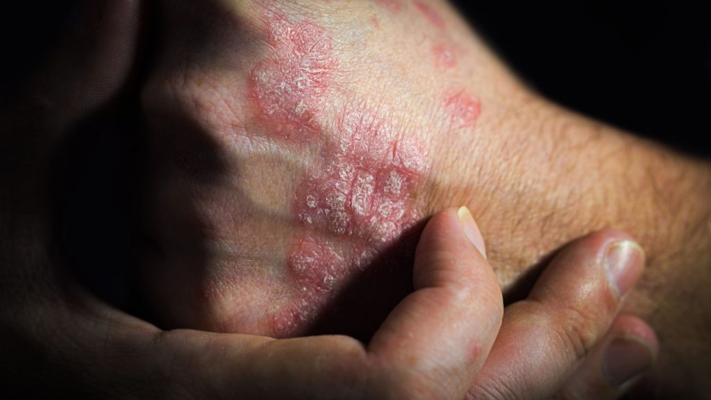 Hidradenitis Suppurativa (HS): An Underdiagnosed And Painful Condition ...