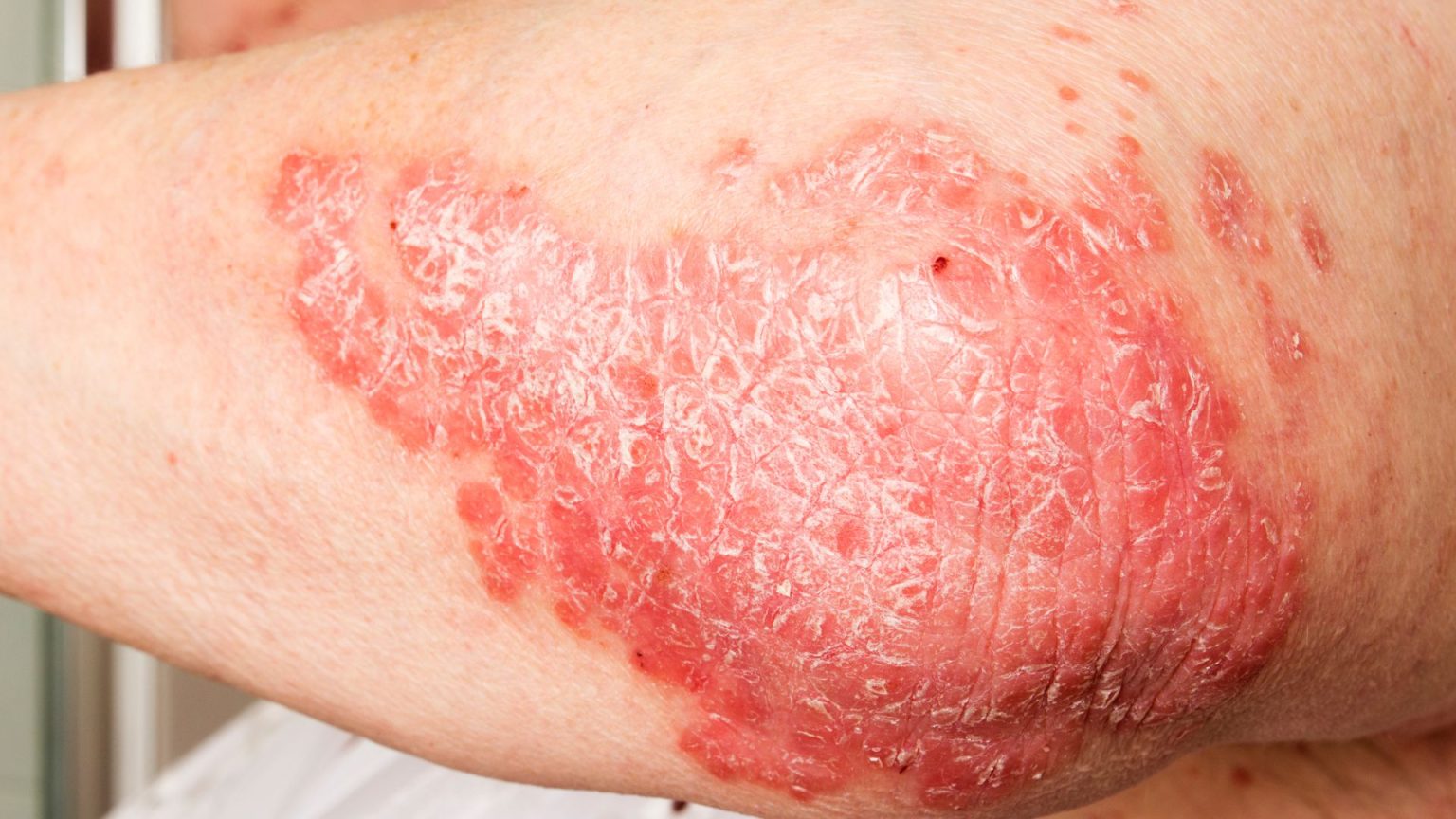 Skin Disease Symptoms | Hidradenitis Suppurativa (HS)