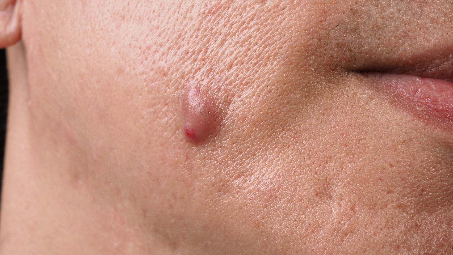 Uncovering Common Misdiagnoses Of Hidradenitis Suppurativa Uncovering Common Misdiagnoses Of Hidradenitis Suppurativa