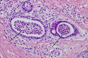 Canadian Hidradenitis Suppurativa Foundation | HS Skin Disease